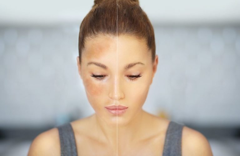 9 Best Natural Remedies for Hyperpigmentation